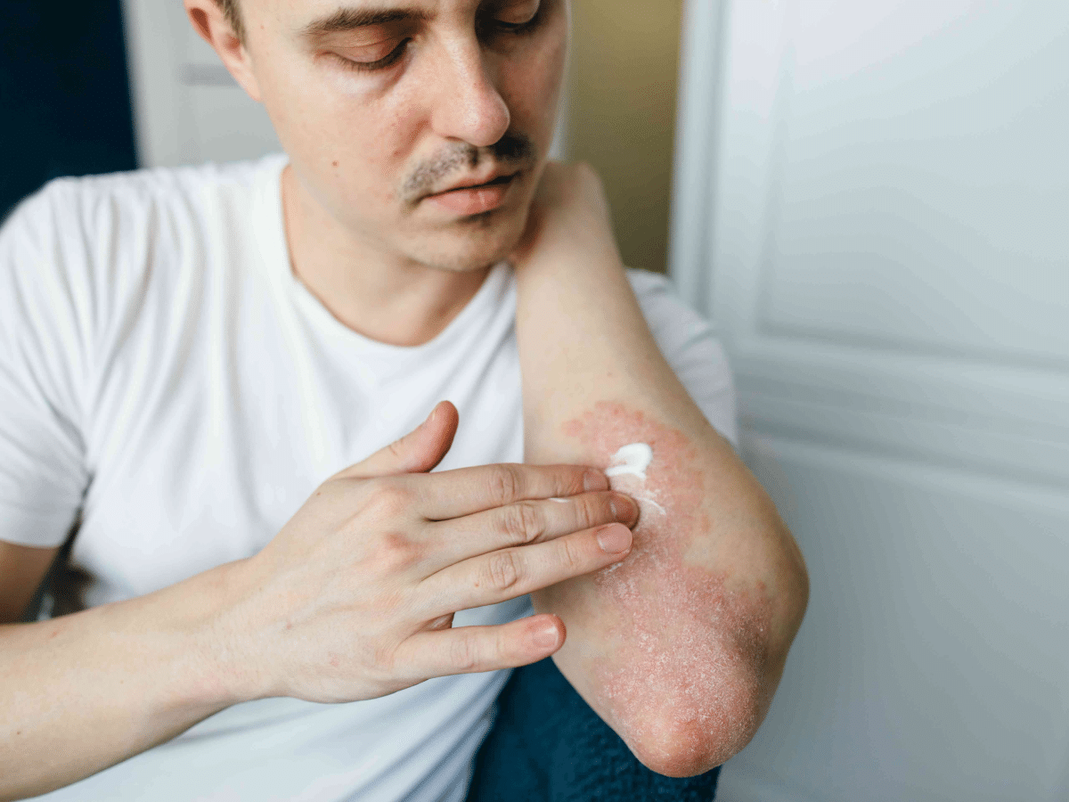 What causes Eczema? 6 effective ways to manage this incurable skin ...